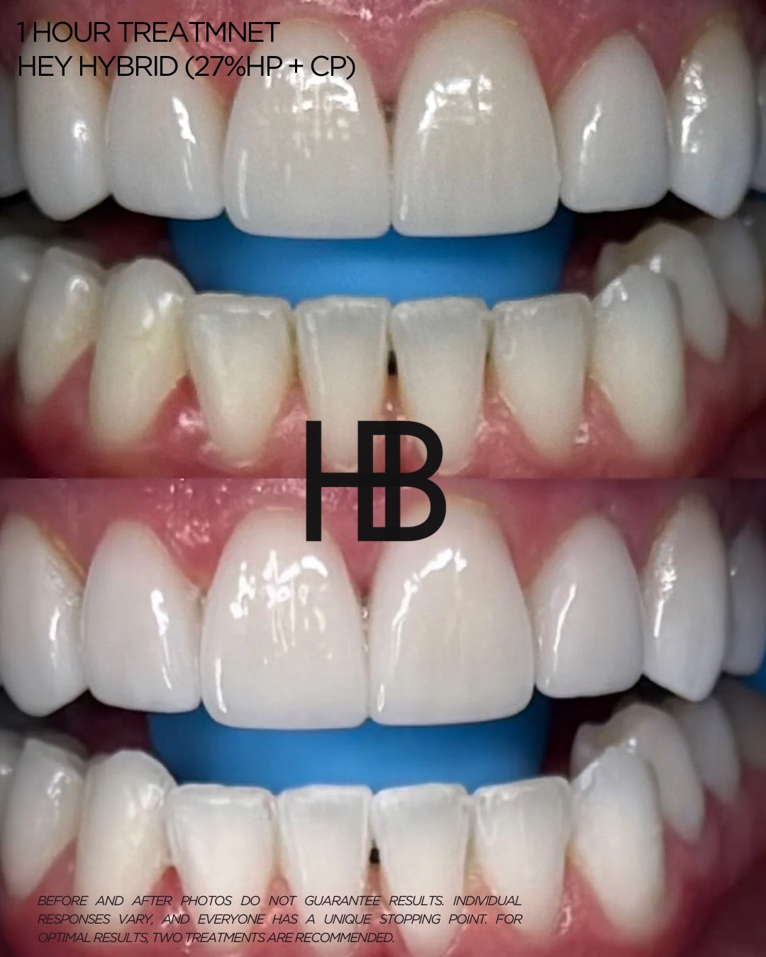 Hey Bright Teeth Whitening